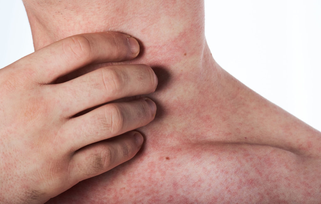 5 Warning Signs You May Have a Food Sensitivity - Carolinas Natural ...